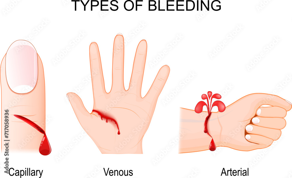 Types of bleeding. A Capillary, Venous and Arterial blood loss Stock ...
