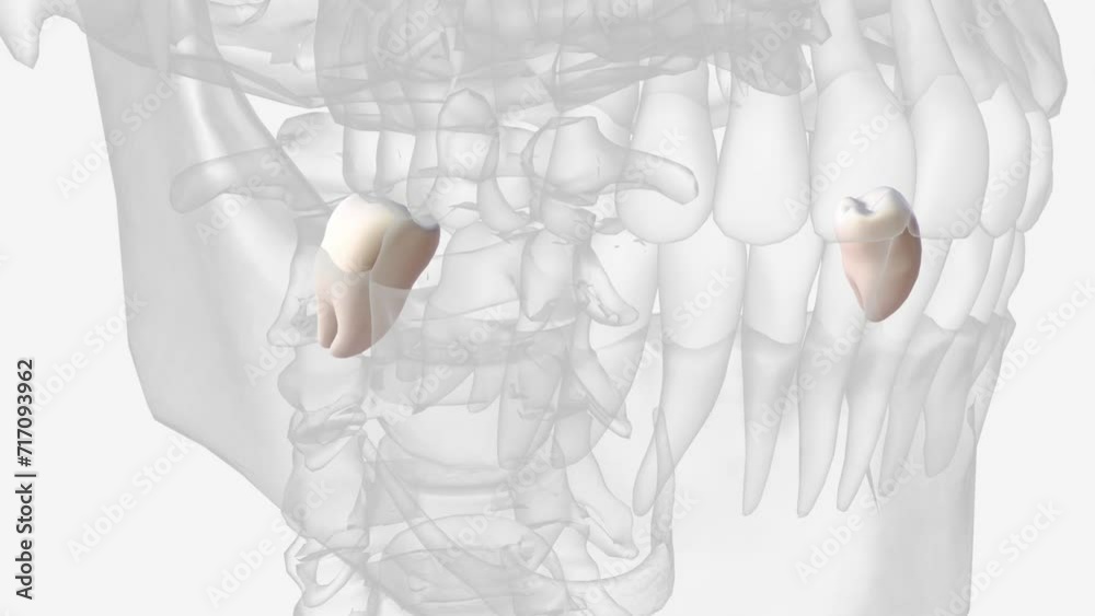 Mandibular third molars usually have two roots: mesial and distal as on ...