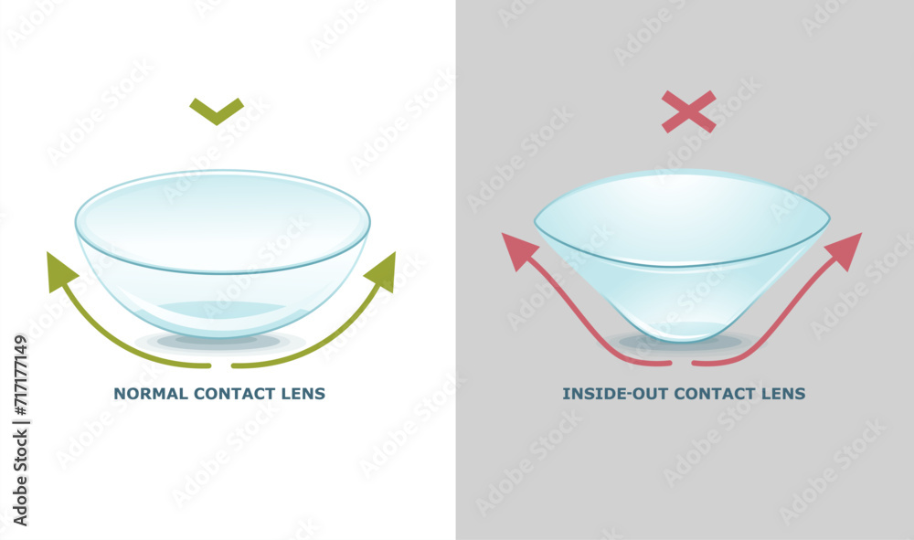 Vecteur Stock Normal contact lens, inside-out contact lens. How to ...
