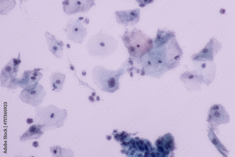 Abnormal squamous epithelial cells view in microscopy.Humanpapilloma ...