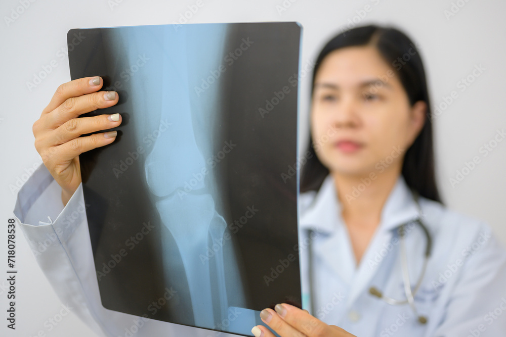 Asian female orthopedic surgeon in white uniform holds orthopedic x-ray ...