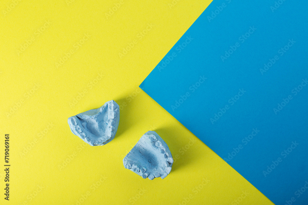 Blue plaster impression of a patient's dental jaw with crooked teeth ...