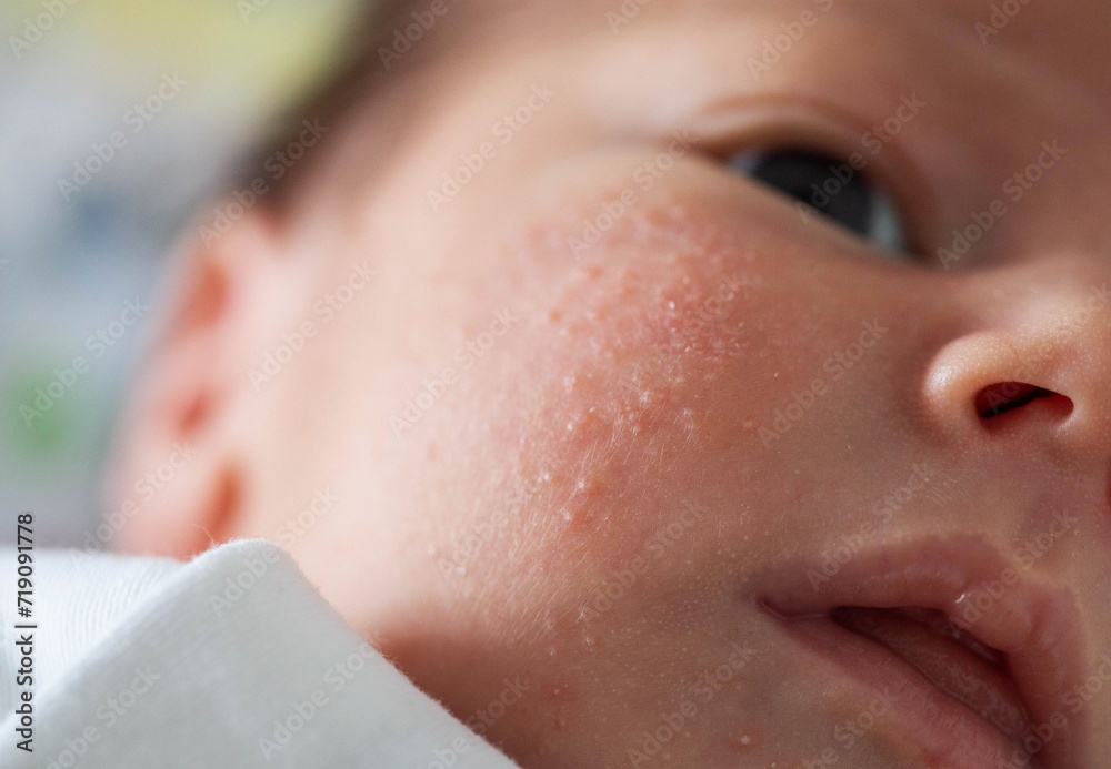 Rash on the face of a newborn baby. The process of formation of the ...