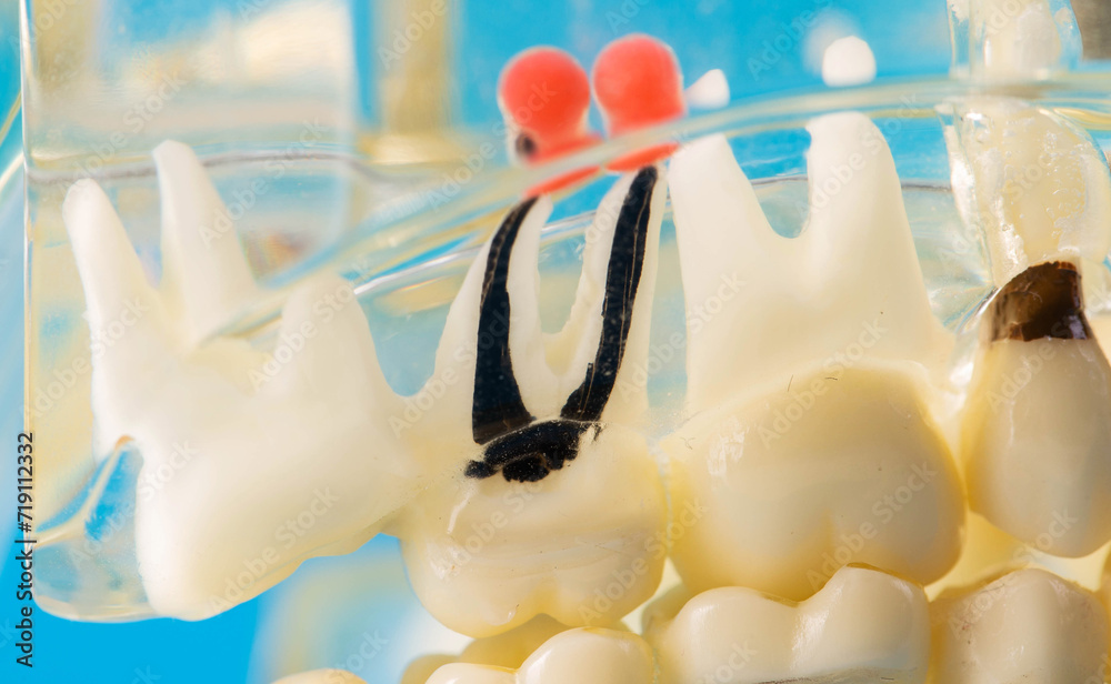 Mockup of a dental jaw with diseased teeth. Inflamed tooth canal ...