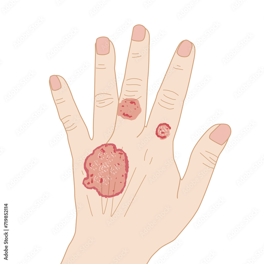 Poster Eczema hand, itching from urticaria or atopic dermatitis ...