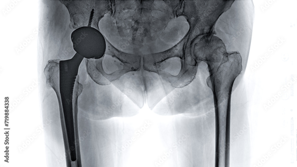 An X-ray reveals both hip joints with TOTAL HIP ARTHROPLASTY ...