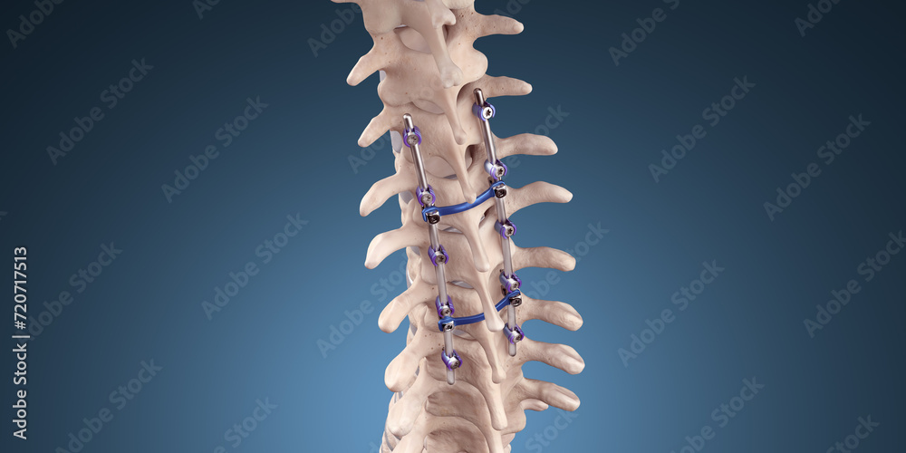 Spine Posterior Thoracic Fusion with Pedicle Screws and Rods on Blue ...