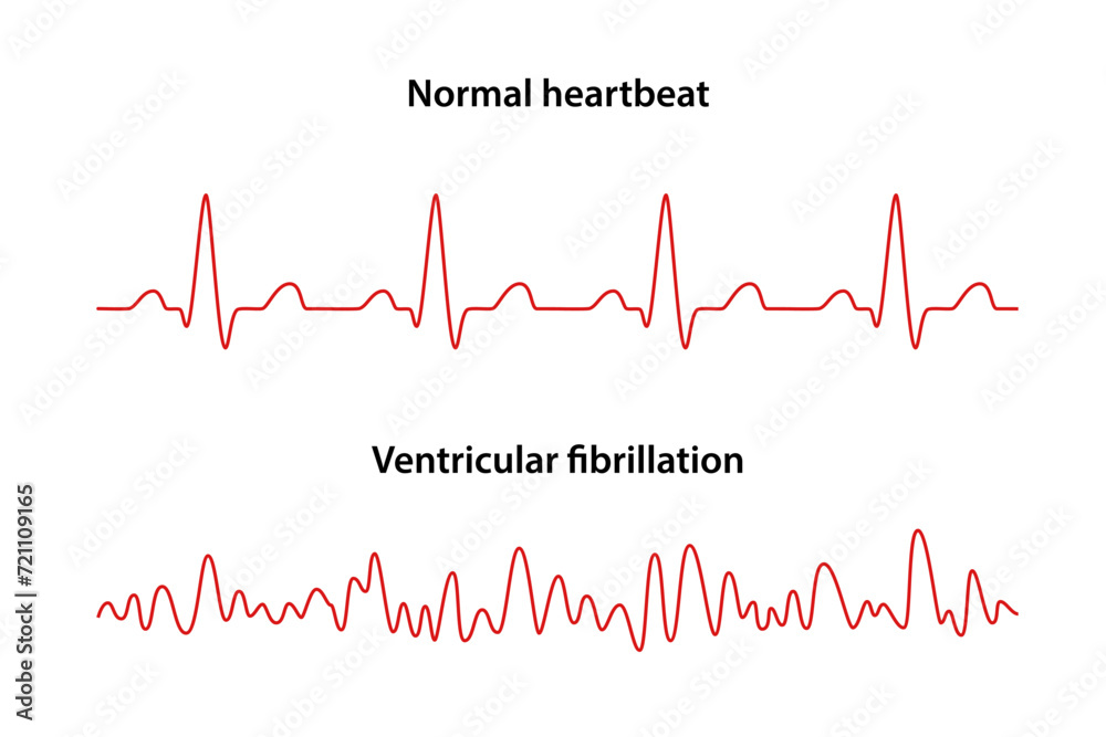 Diagram of normal rhythm and Ventricular fibrillation for a human heart ...