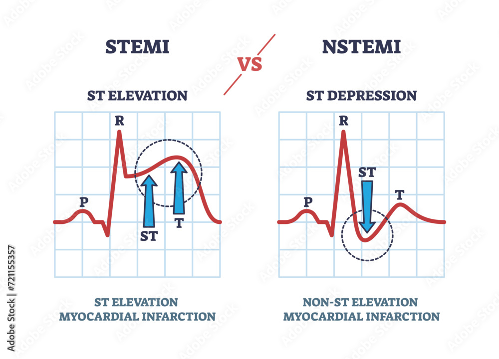 STEMI vs NSTEM heart beat impulse in cardio visualization outline ... STEMI vs NSTEM heart beat impulse in cardio visualization outline ...