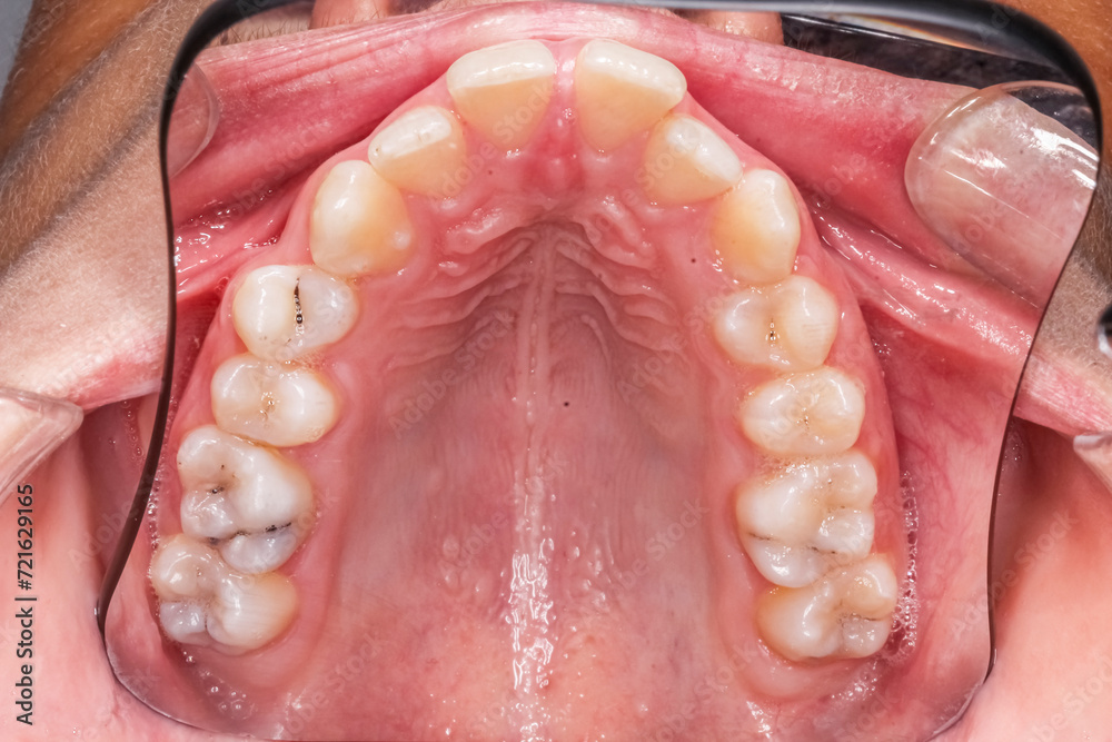 Dentistry orthodontics case of upper maxillary arch, indirect occlusal ...
