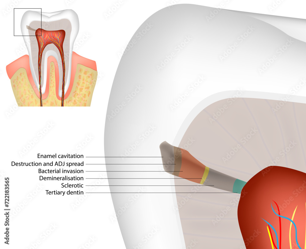Histopathology of Caries in Enamel and Dentine. Enamel Dentin Pulp ...