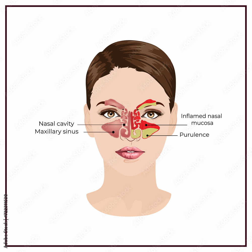 Anatomical illustration of the maxillary sinus. Diagnosis of maxillary ...