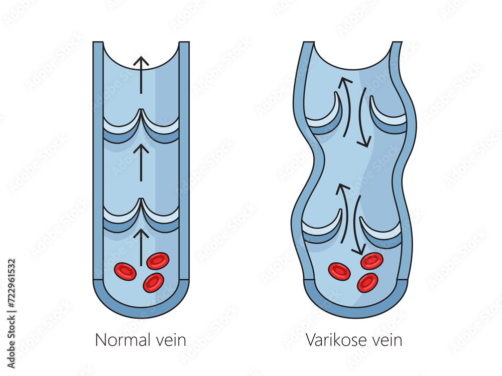 healthy and varicose veins structure diagram hand drawn schematic ...