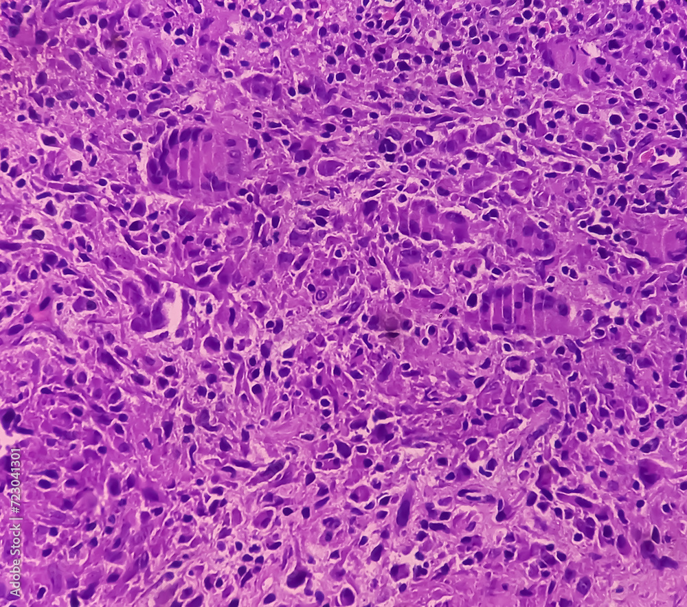 Cold abscess wall (biopsy). Chronic granulomatous inflammation (CGI ...