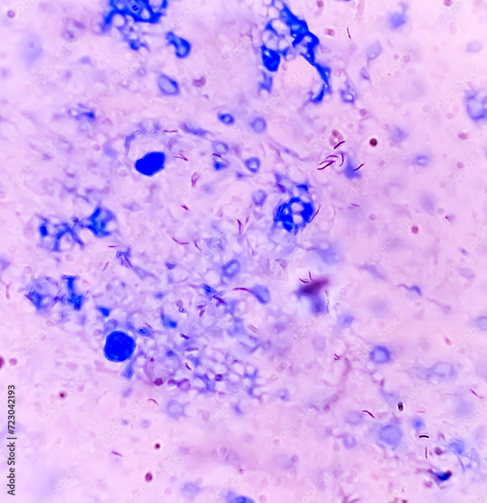 Mycobacterium tuberculosis in Sputum under light microscope. AFB stain ...