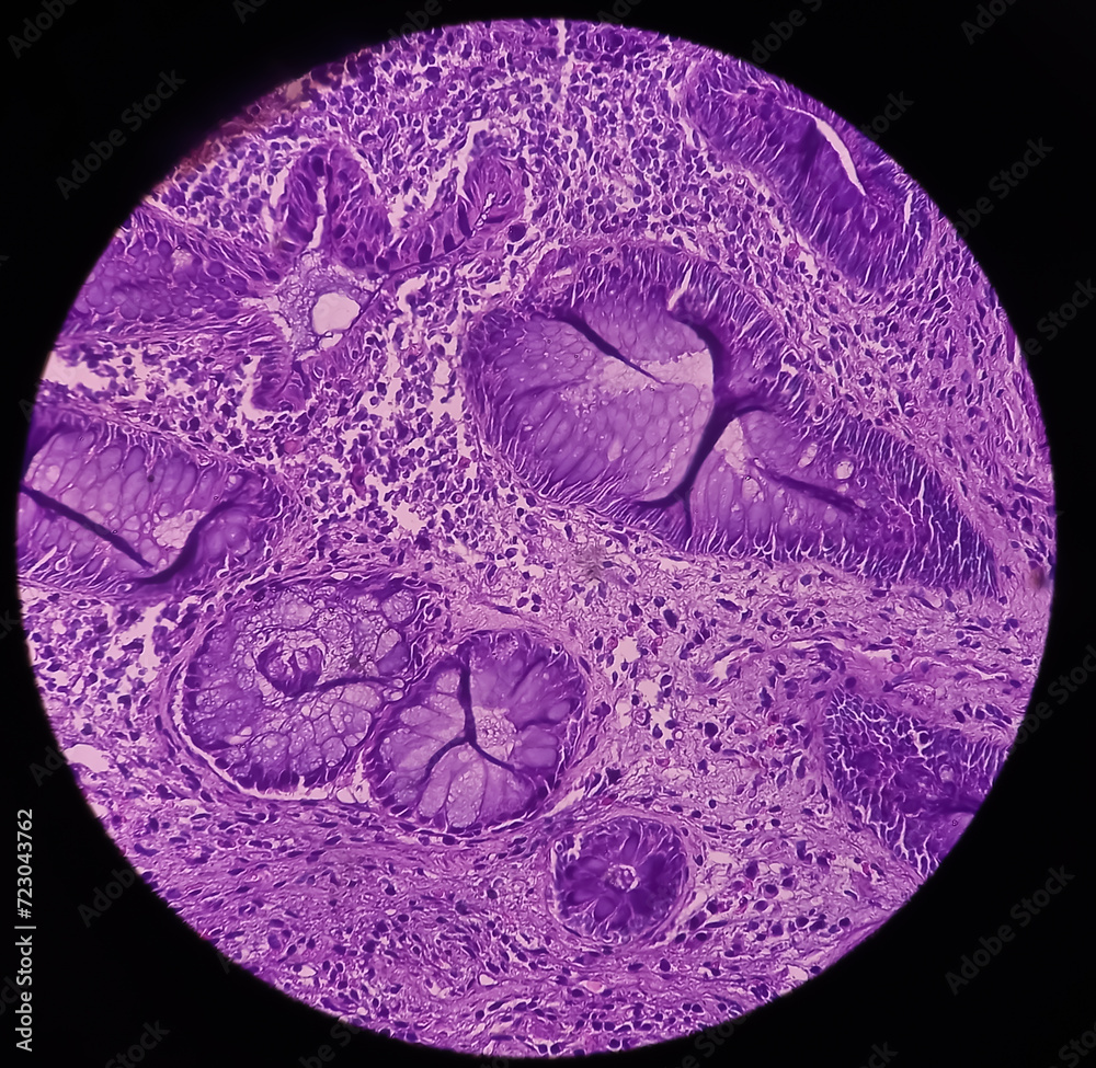 Rectal cancer. Rectum adenocarcinoma. IBD. IBS. Squamous cell carcinoma ...
