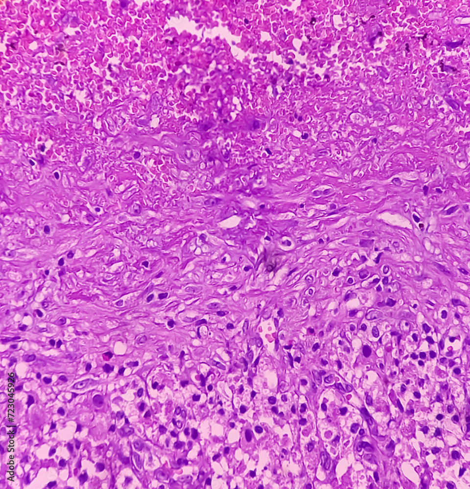 Ovarian cyst: Haemorrhagic cyst. Microscopic show ovarian cyst wall of ...