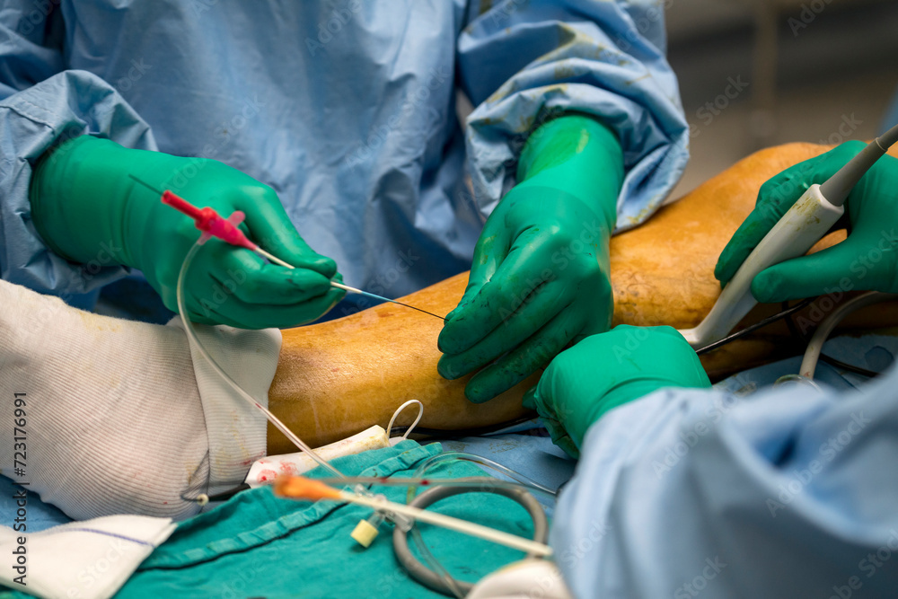 Process Of Varicose Vein Surgery In Hospital Vein Sealing Venous