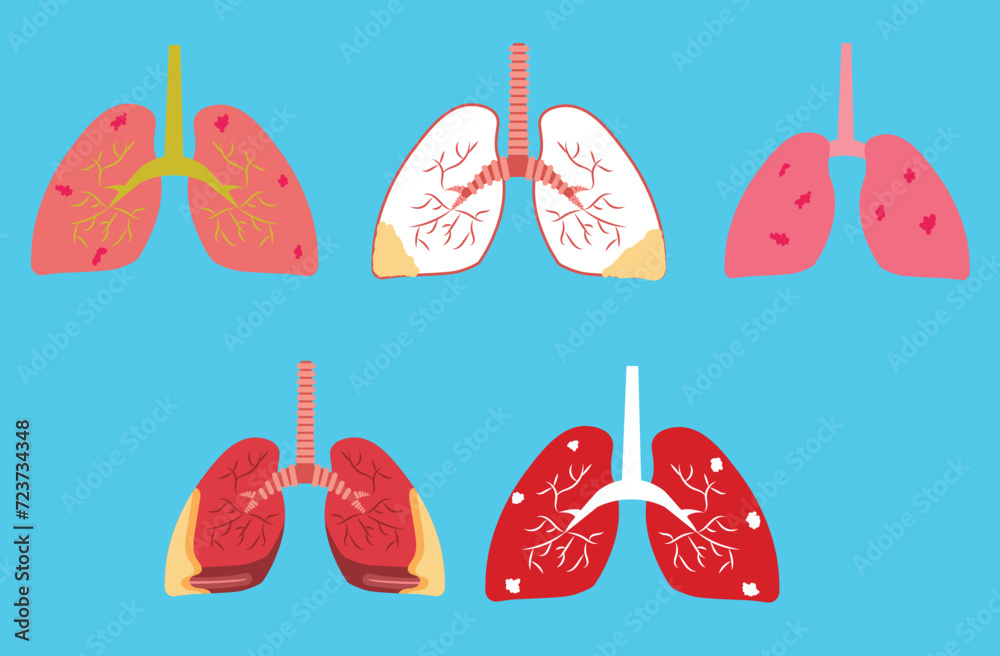 asbestosis,Asbestosis anatomical poster. Lung disease concept, asbestos ...