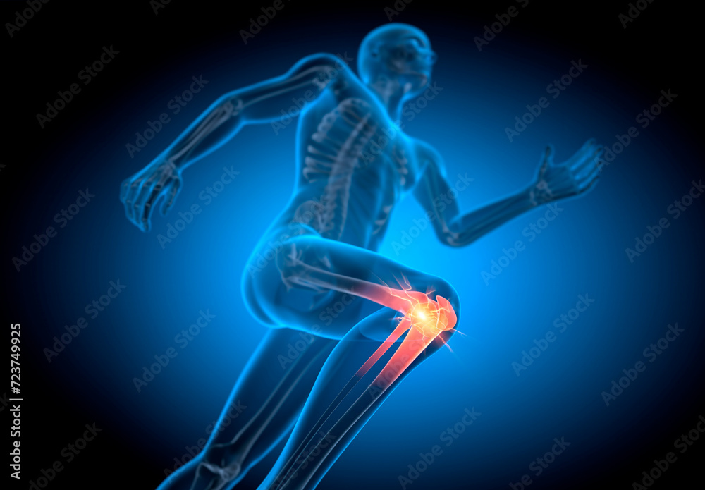 X ray illustration of a running man with pain in knee joint - 3D ...
