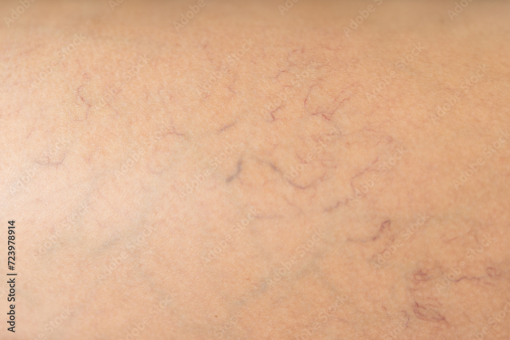 Varicose veins. Vascular diseases. Varicose veins of small vessels on ...