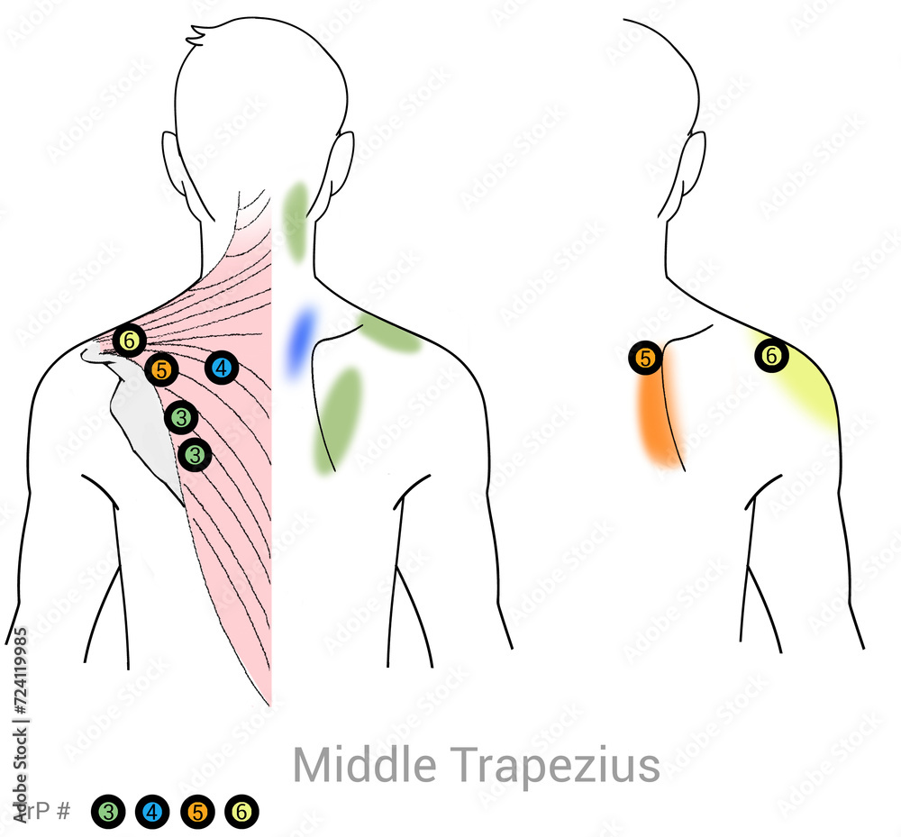 Middle Trapezius: Myofascial trigger points and associated pain ...