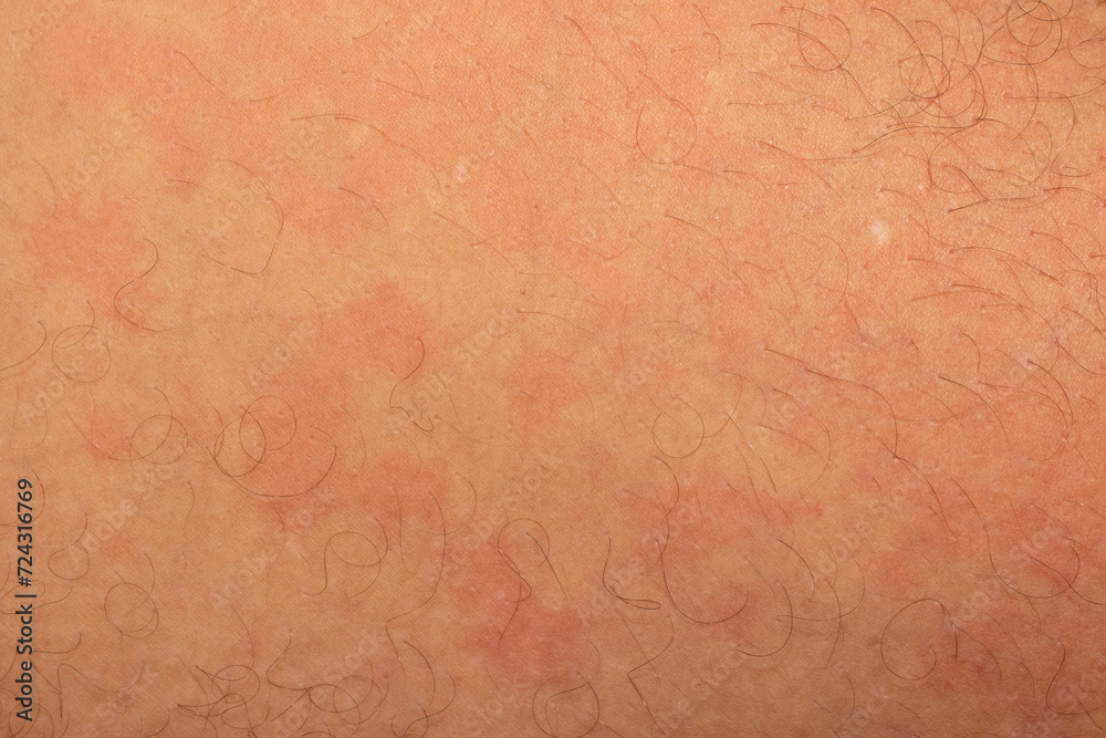 vesicular rash reaction from drug allergy. Stock Photo | Adobe Stock