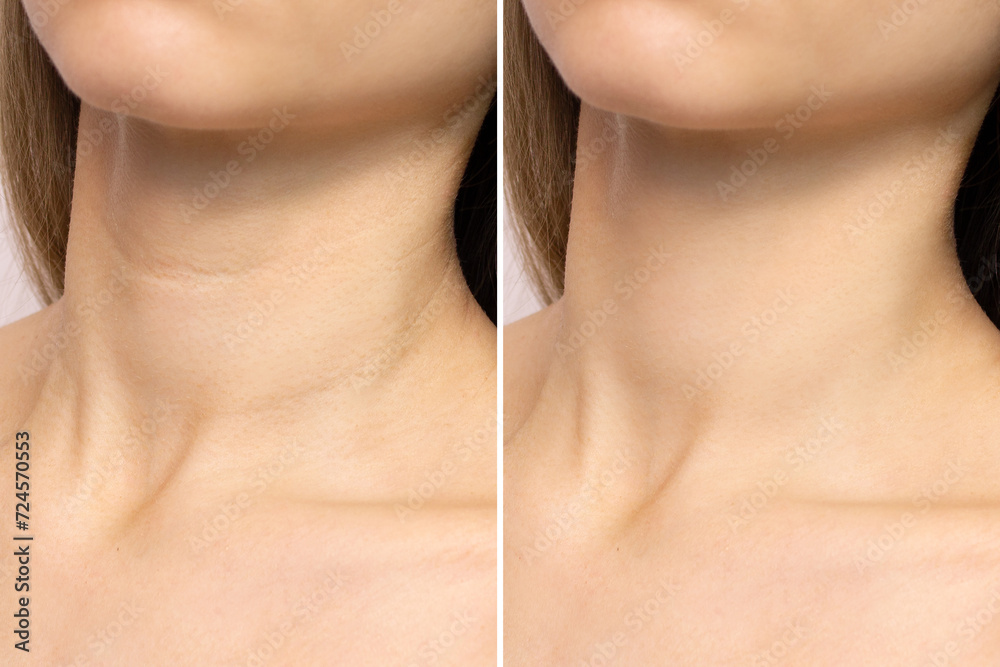 Crease and wrinkles on a woman’s neck before and after the rejuvenation ...