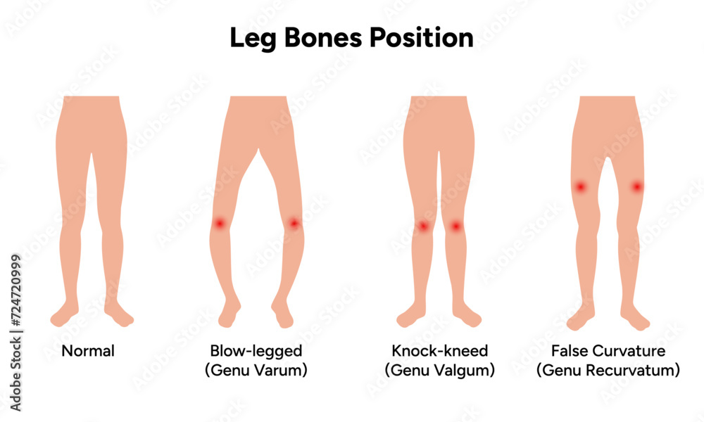 Leg bones position Blowlegged knock kneed face curvature Stock Vector ...