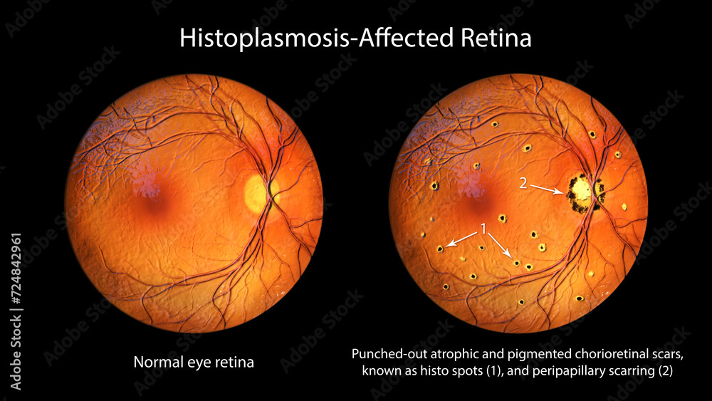 Retina in Ocular Histoplasmosis Syndrome, 3D illustration Stock ...