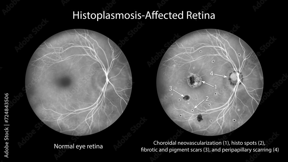 Retina in Ocular Histoplasmosis Syndrome, illustration Stock ...