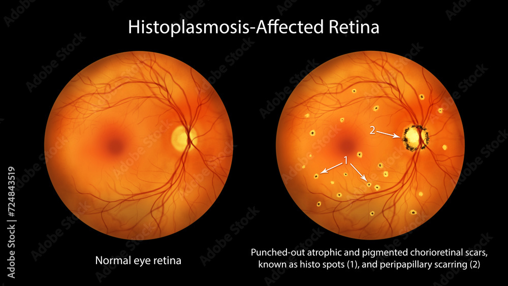 Retina in Ocular Histoplasmosis Syndrome, illustration Stock ...