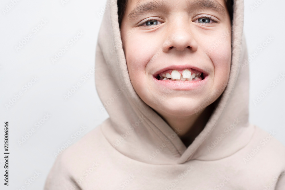 A young boy shows his teeth, permanent teeth are already growing to ...