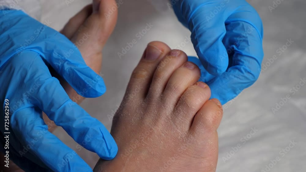 Vidéo Stock A dermatologist examines a patient's feet. Allergic rash ...