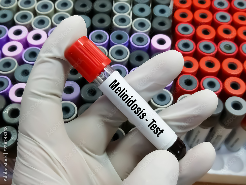 Blood sample for with Melioidosis test, also called Whitmore's disease ...