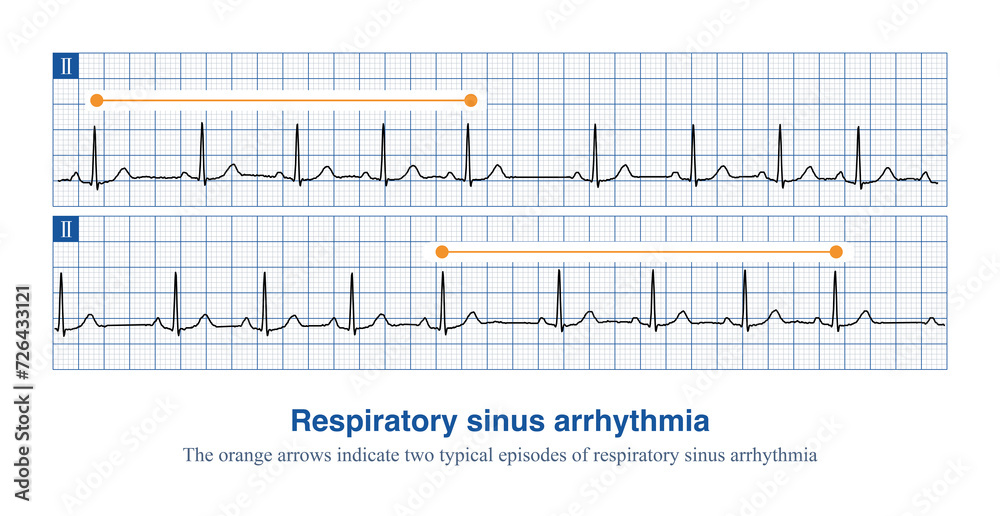Respiratory sinus arrhythmia is diagnosed when the heart rate increases ...