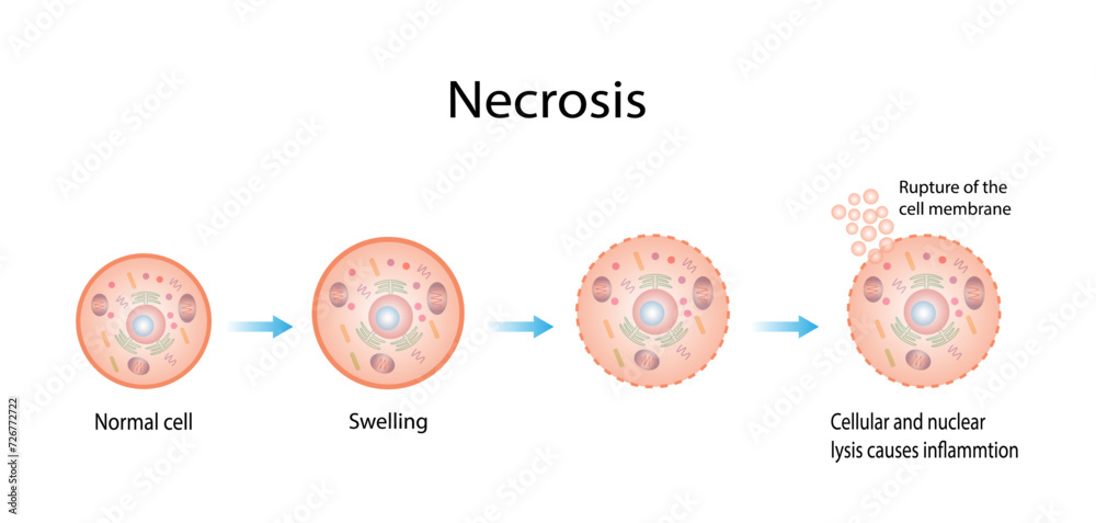 Vecteur Stock Necrosis, Pathologic Cell Death, Death of the body ...