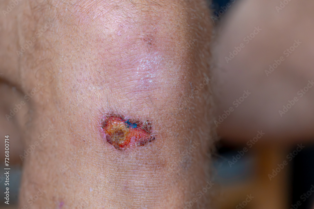 First aid and injuries concept, A man show his leg with little bit ...