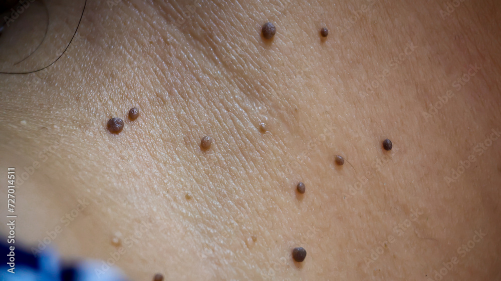 High-resolution close-up image showcasing skin tags, also known as ...