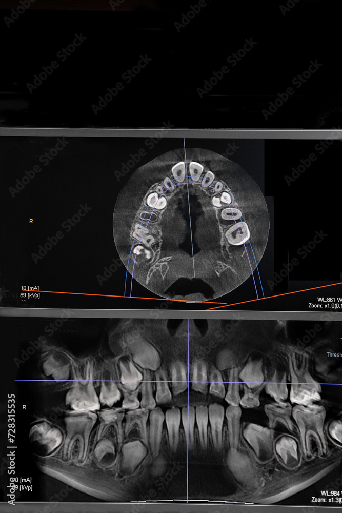 CT image of the teeth of a 9-year-old child, with baby teeth, in ...