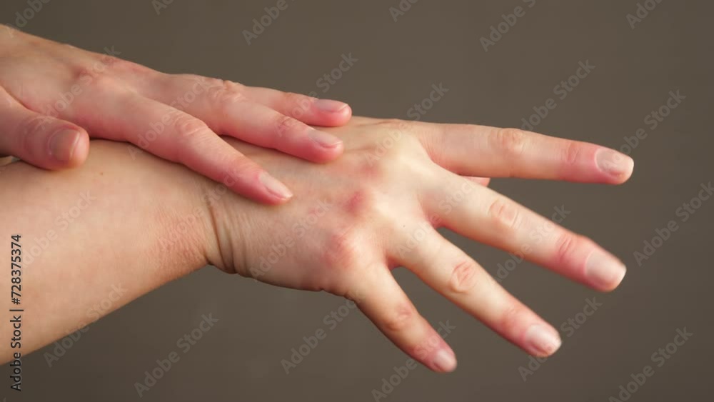 Close-up of the skin of the hands. Atopic dermatitis on the skin ...