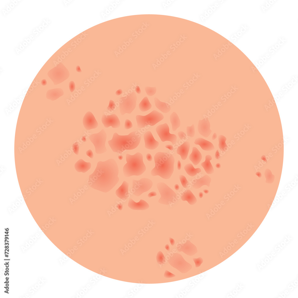 Type of psoriasis vector. Part of patients skin with dermatitis ...