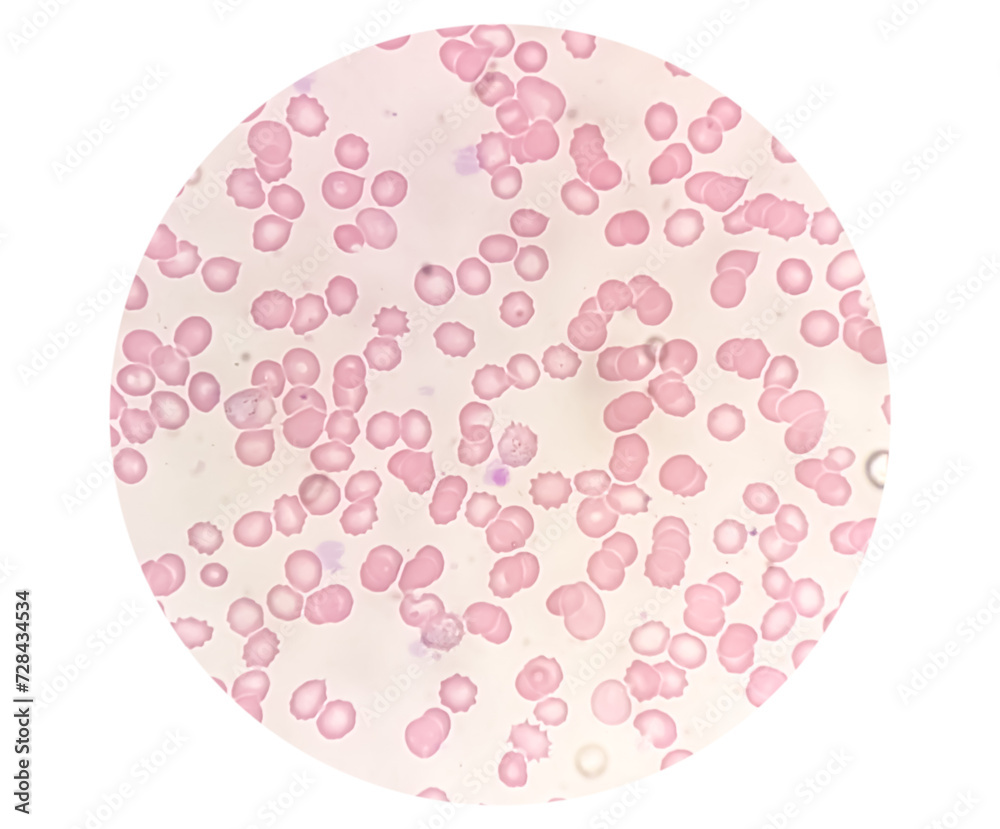 Plasmodium vivax in thin film under microscopy, Malaria disease. P ...