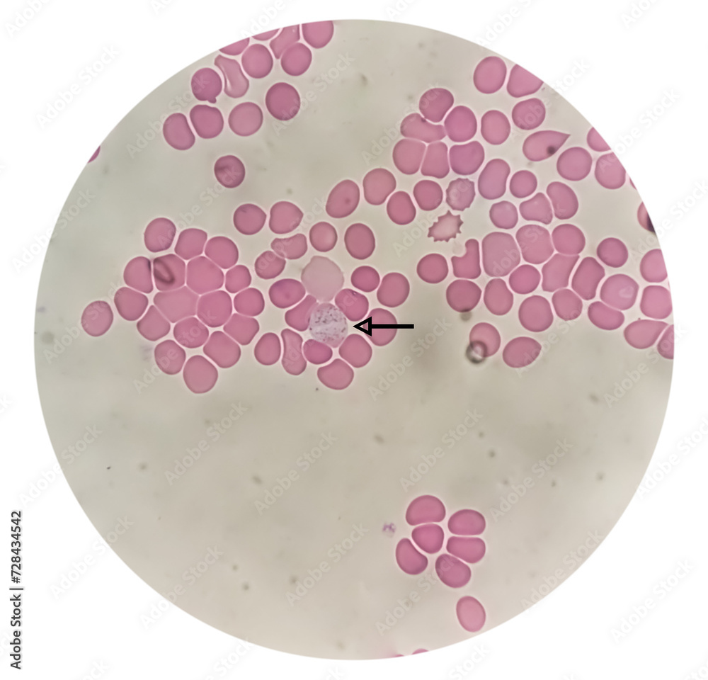 Plasmodium vivax in thin film under microscopy, Malaria disease. P. vivax, Malaria parasite in ...