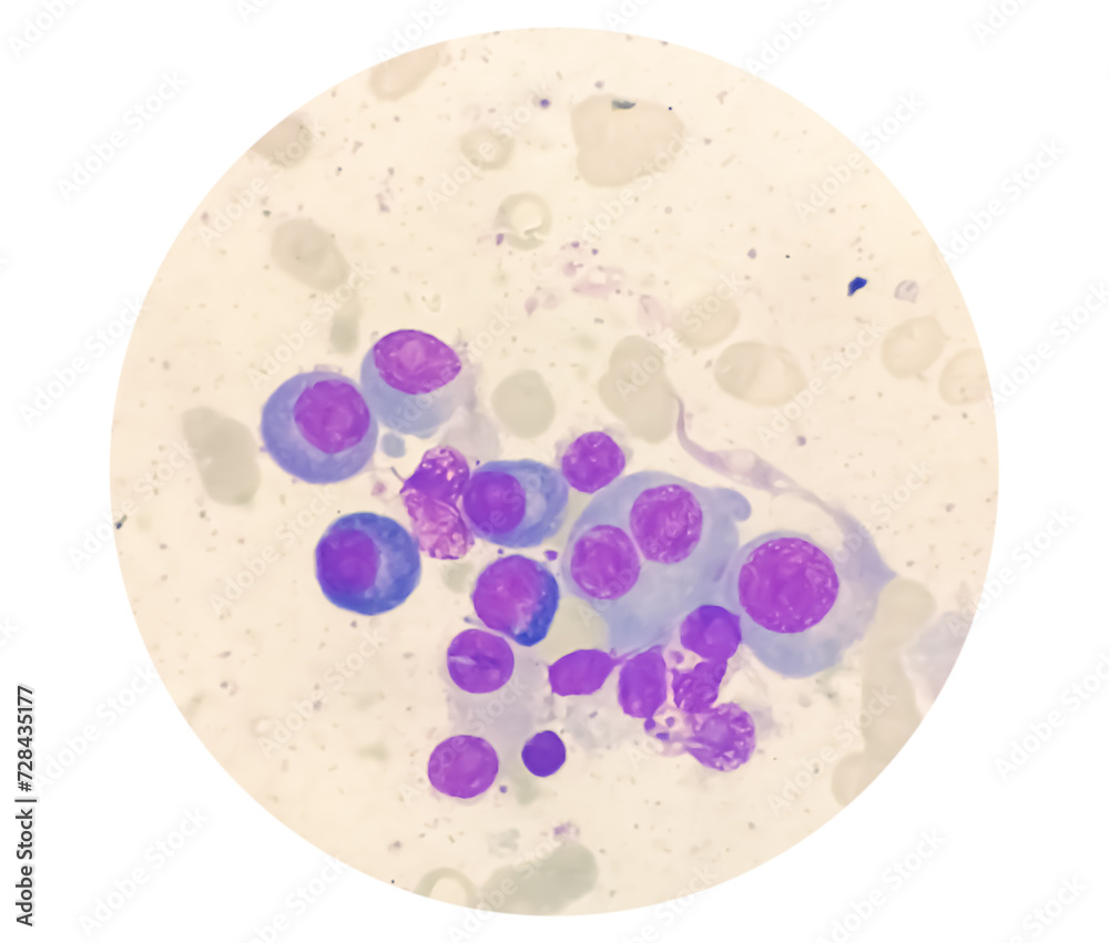 Microscopic view of bone marrow slide showing Multiple myeloma, a type of bone marrow cancer. 스톡 ...