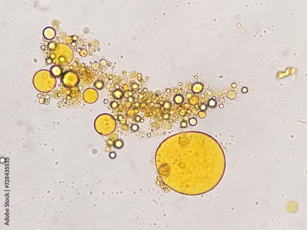 Microscopic stool analysis showing Neutral fat. fecal fat globules ...