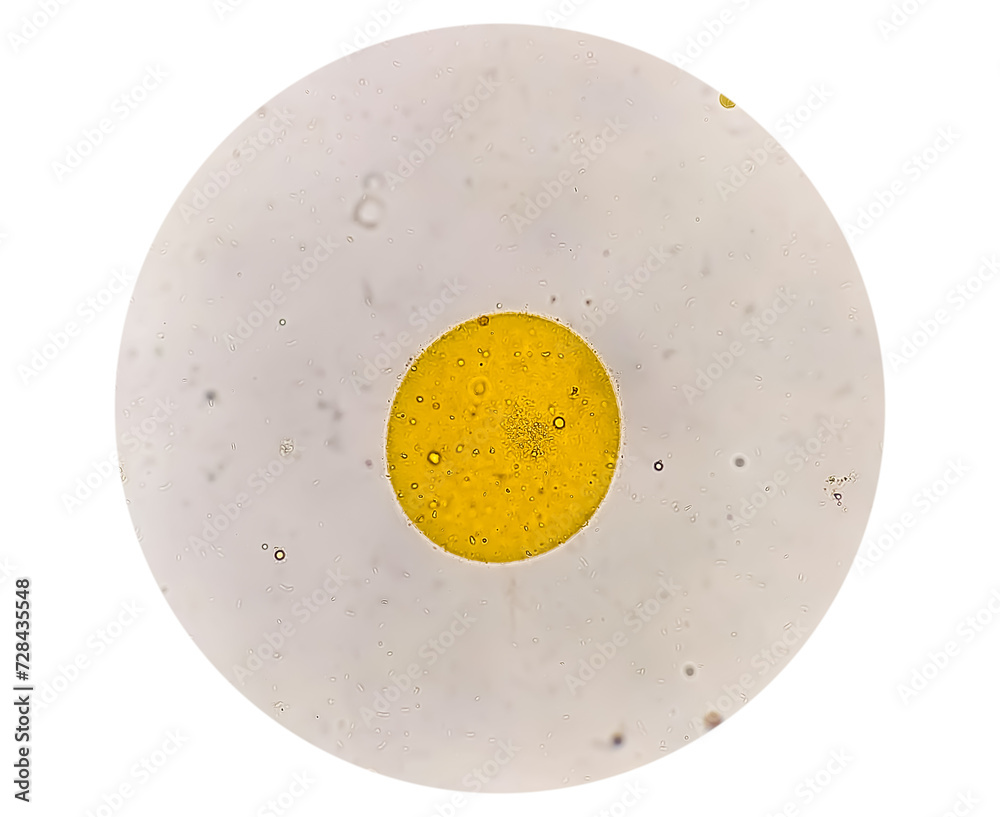 Microscopic stool analysis showing Neutral fat. fecal fat globules ...