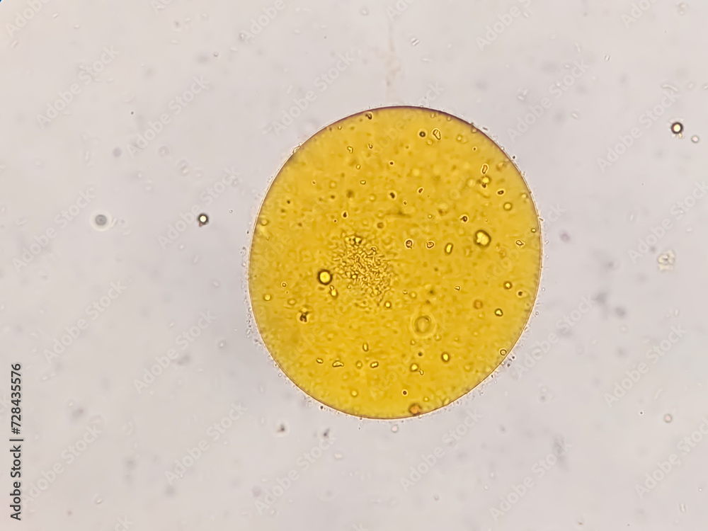 Microscopic stool analysis showing Neutral fat. fecal fat globules ...
