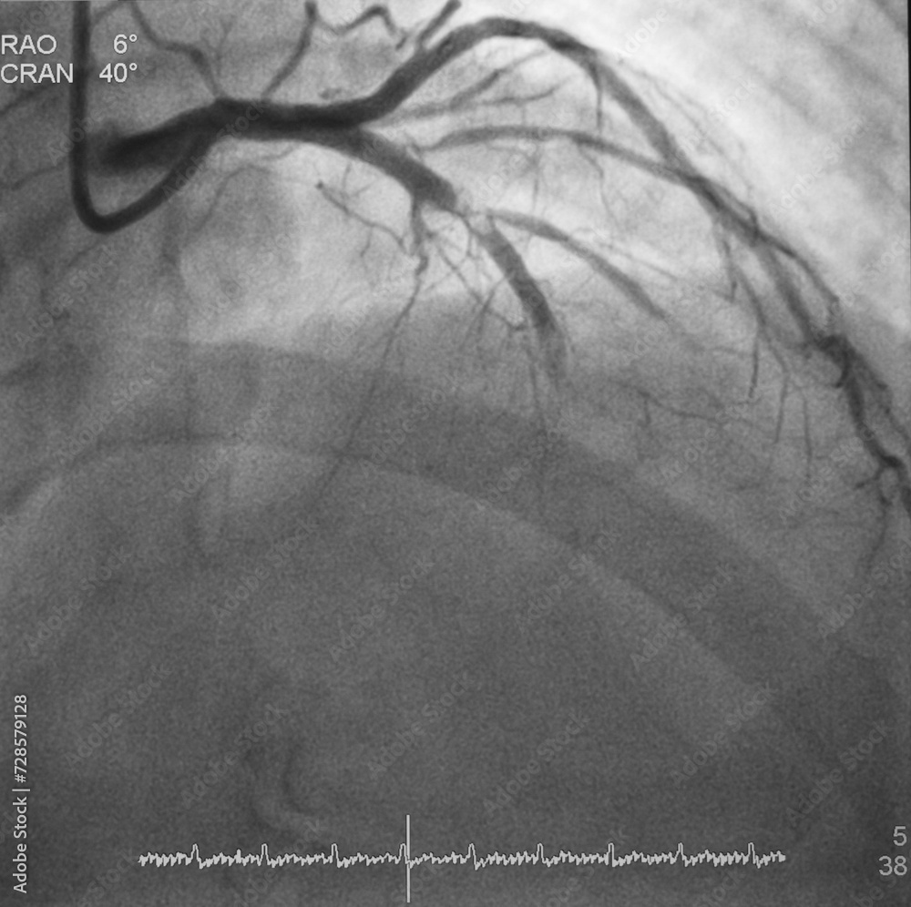 Coronary angiogram (CAG) was performed total occlusion at left anterior ...
