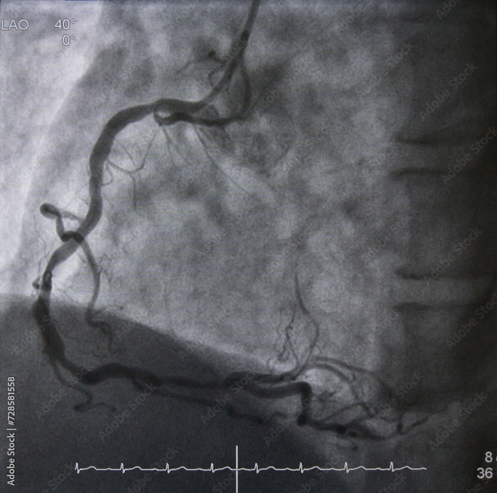 Coronary angiogram (CAG) was performed right coronary artery (RCA ...